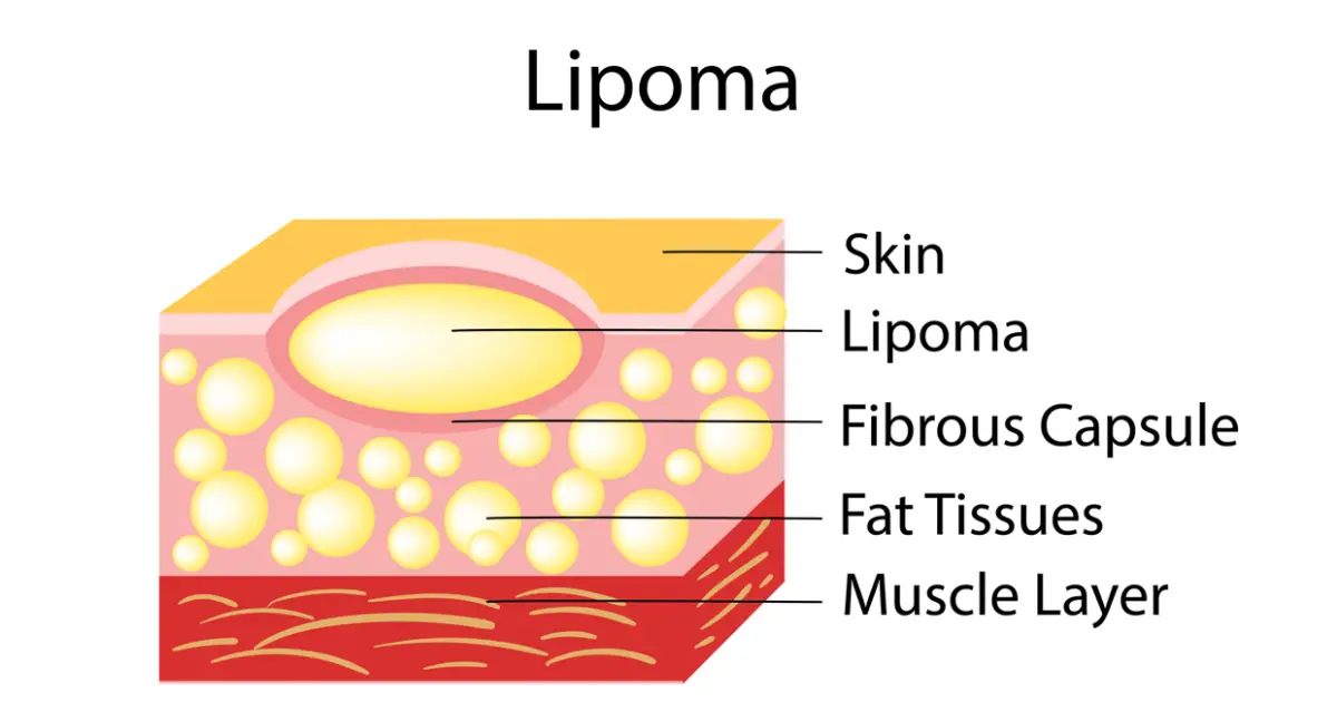 Lipomas in Dogs | Causes, Symptoms & Treatment | World Dog Finder